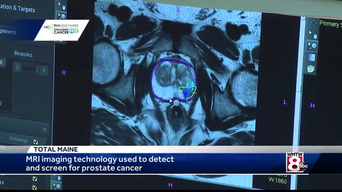 MRI technology used to detect, screen for prostate cancer
