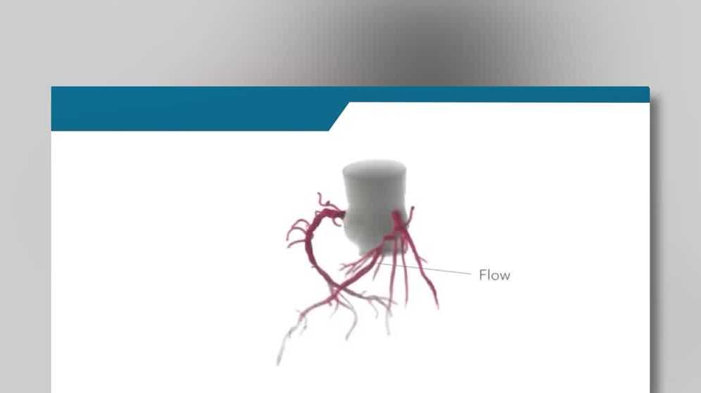 Omaha doctors use new AI technology to detect artery blockage