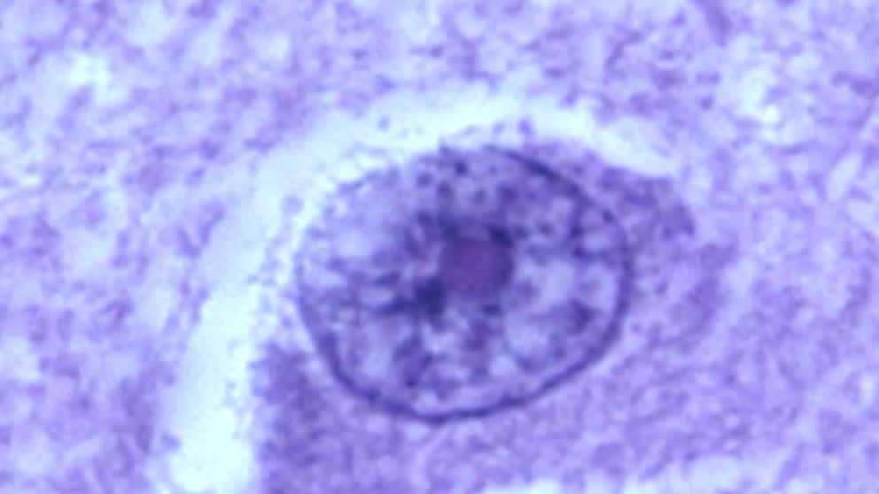 South Carolina: Pediatric patient dies from brain-eating amoeba