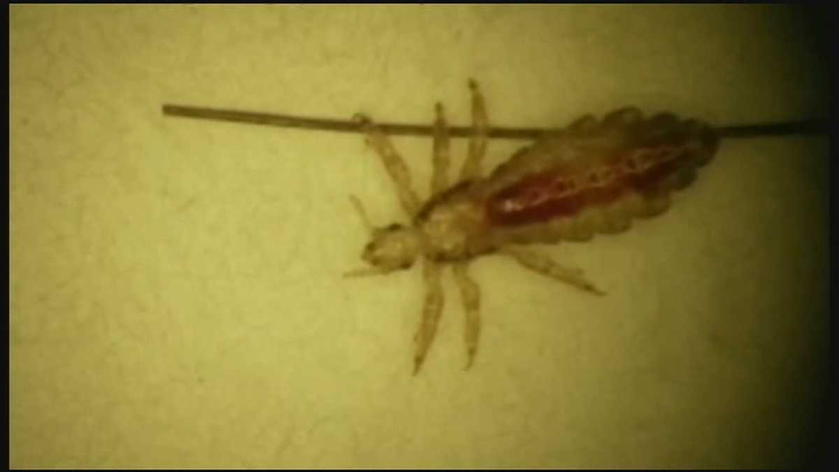 Rise of 'super lice' causes concerns