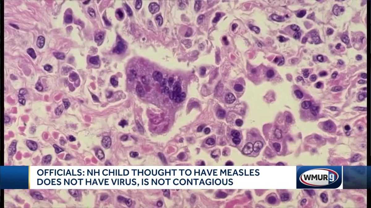 Suspected measles case was reaction to vaccine, officials say