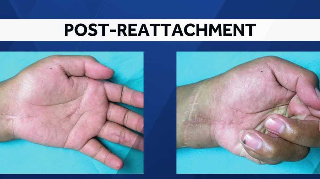 Ask The Doctors: How does hand reattachment work?
