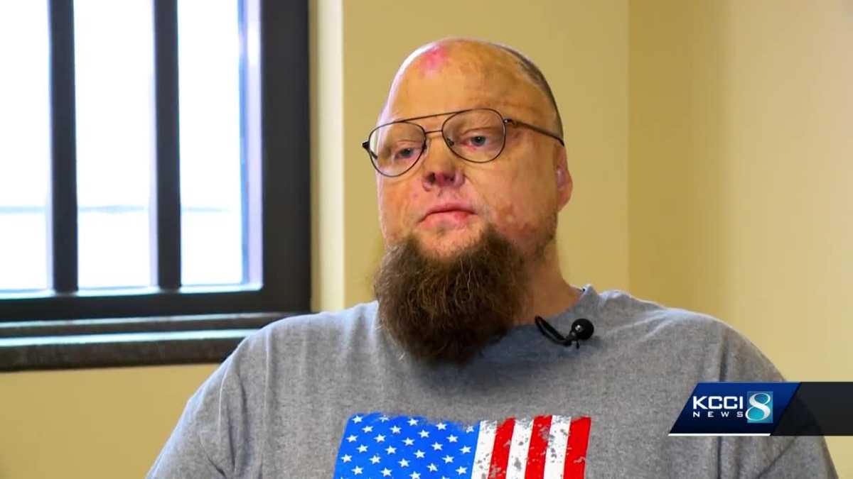 Inmate 'burned alive' in meth explosion continues to struggle with ...