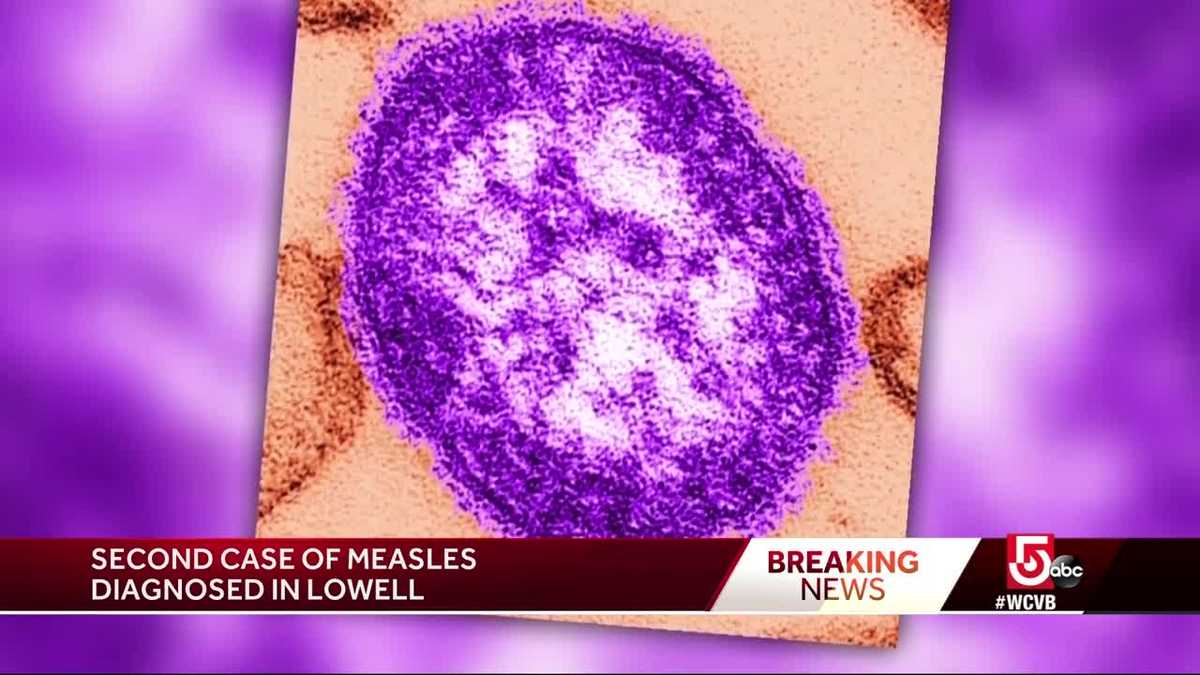 2nd case of Measles diagnosed in Lowell