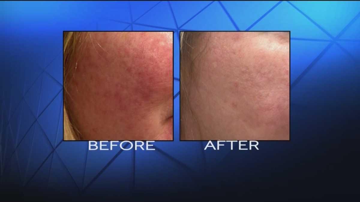 FDA-approved gel helps treat rosacea