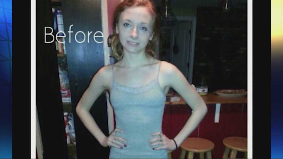 Teen Shares Inspirational Message To Raise Awareness About Anorexia