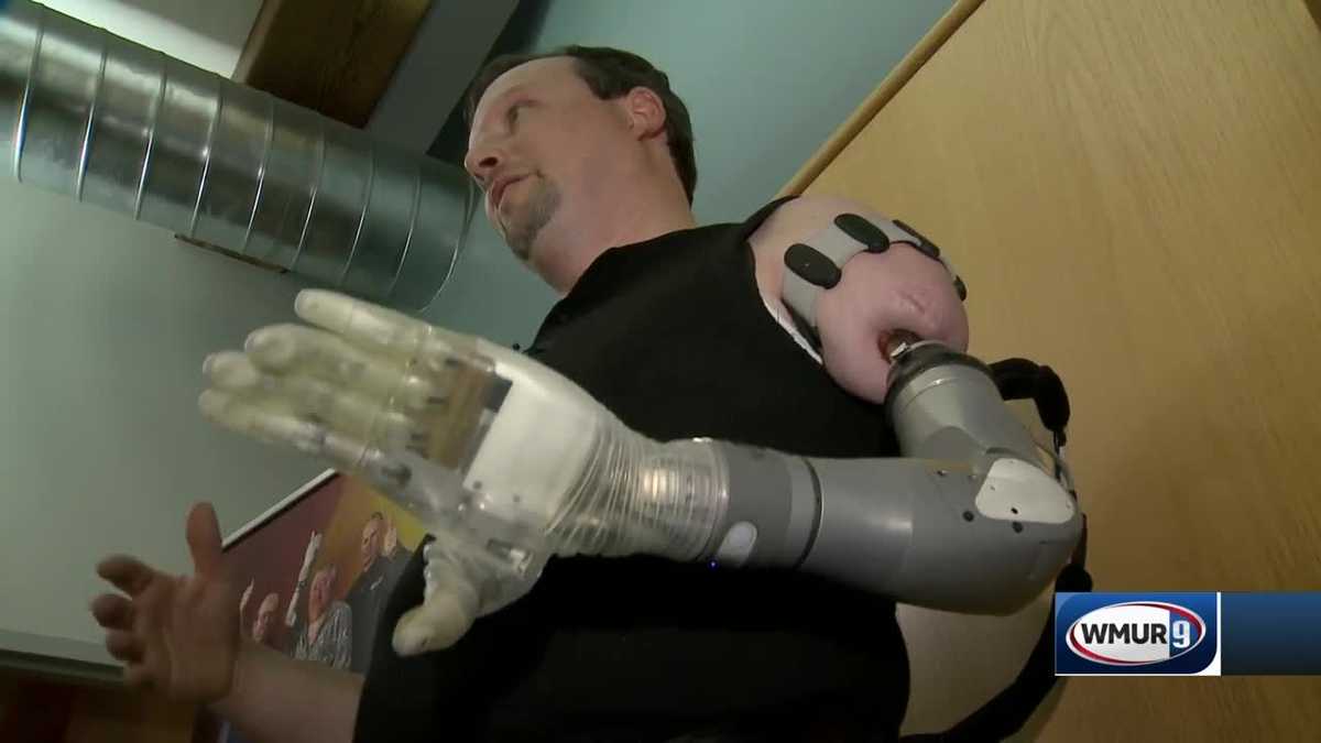 Amputee finds hope with cutting-edge prosthetic developed in NH