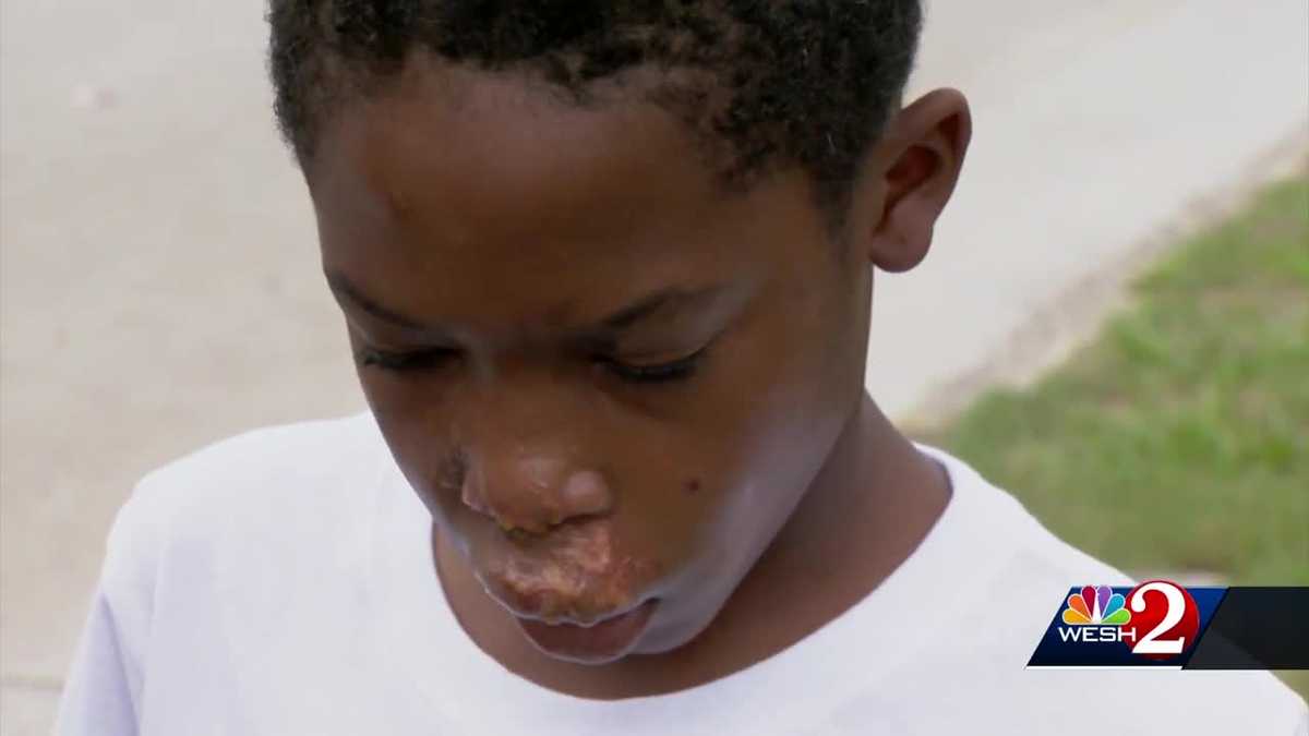 Child recovering from fireworks explosion: 'I thought I was going to die'