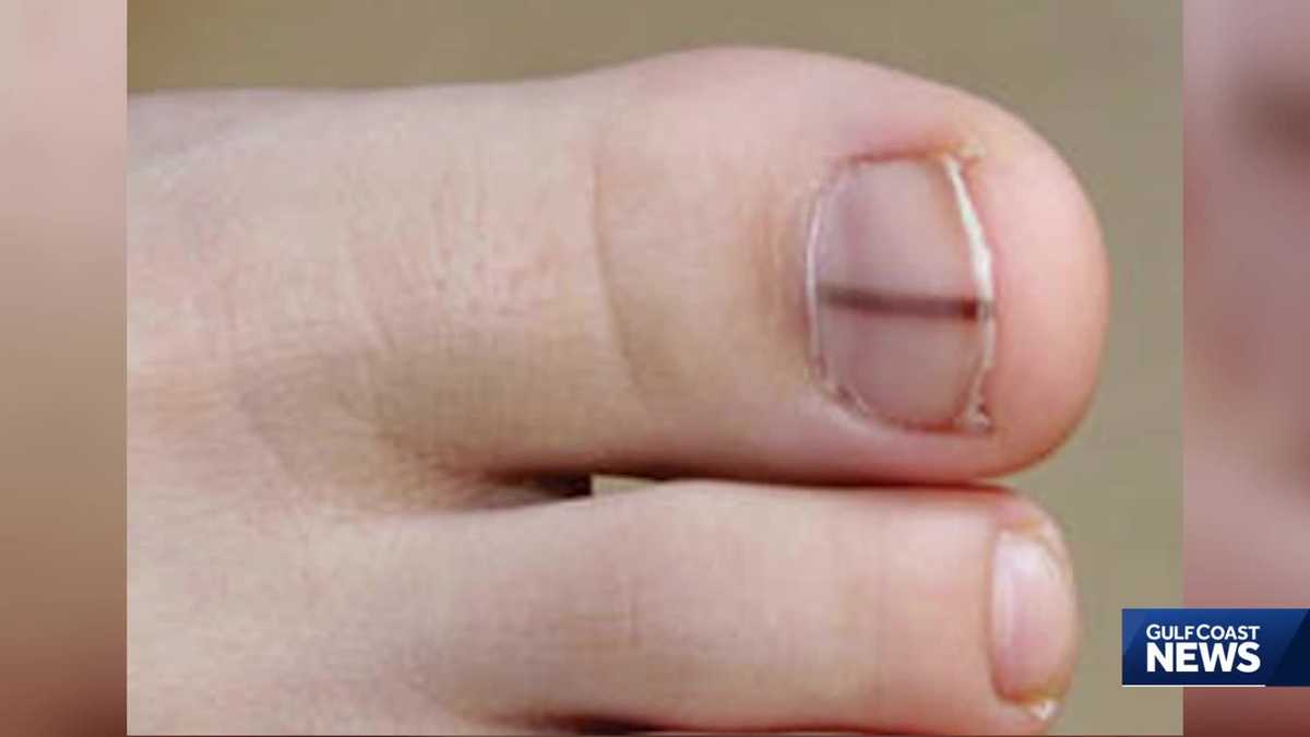 What are the dark spots under your nails with Dr. Kim