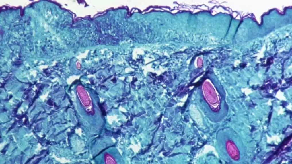 First case of monkeypox confirmed in Indiana