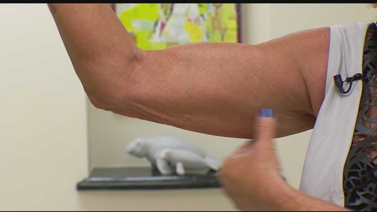 Procedure helps improve appearance of arms