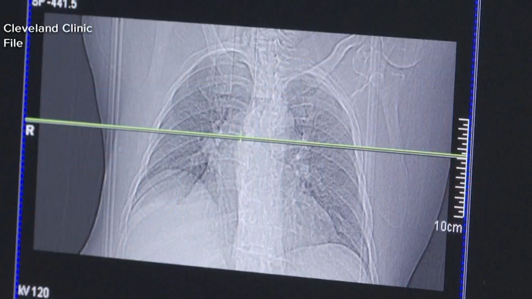 Homeless man with tuberculosis ordered to isolate