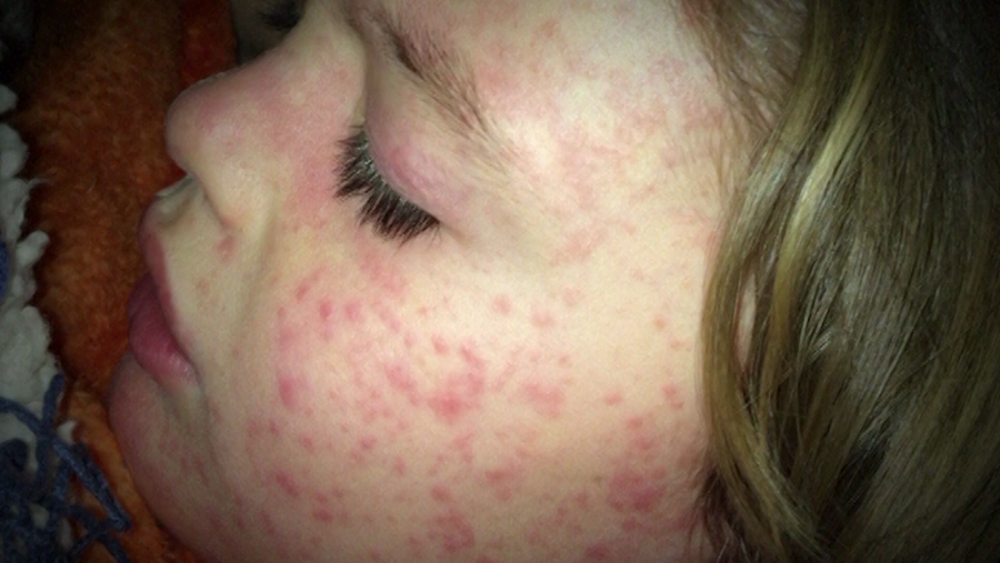 Religious exemption targeted amid measles outbreaks