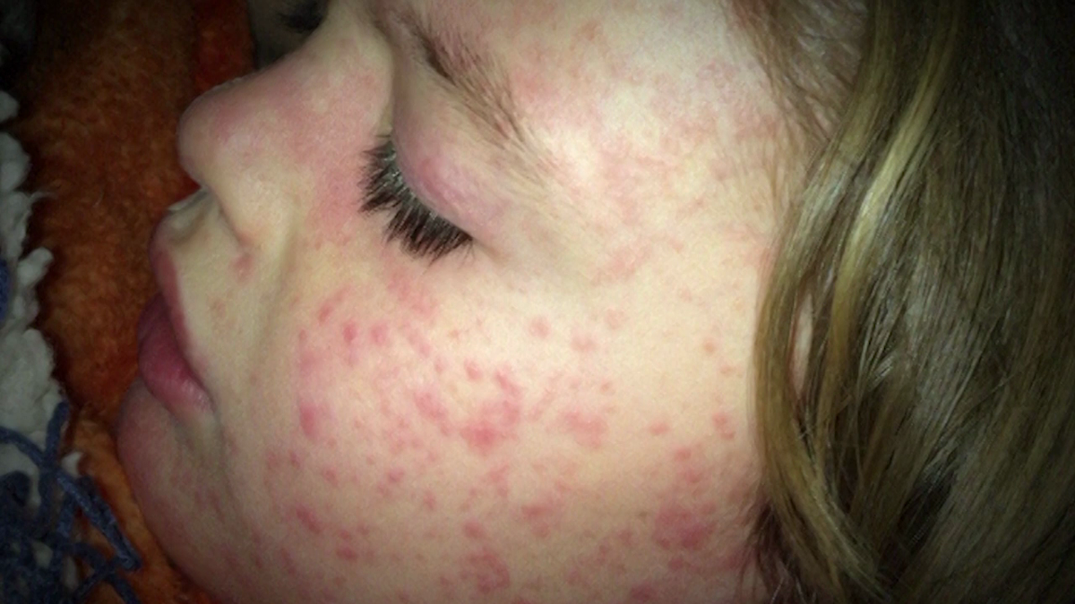 Measles alert at multiple Massachusetts locations after person ...