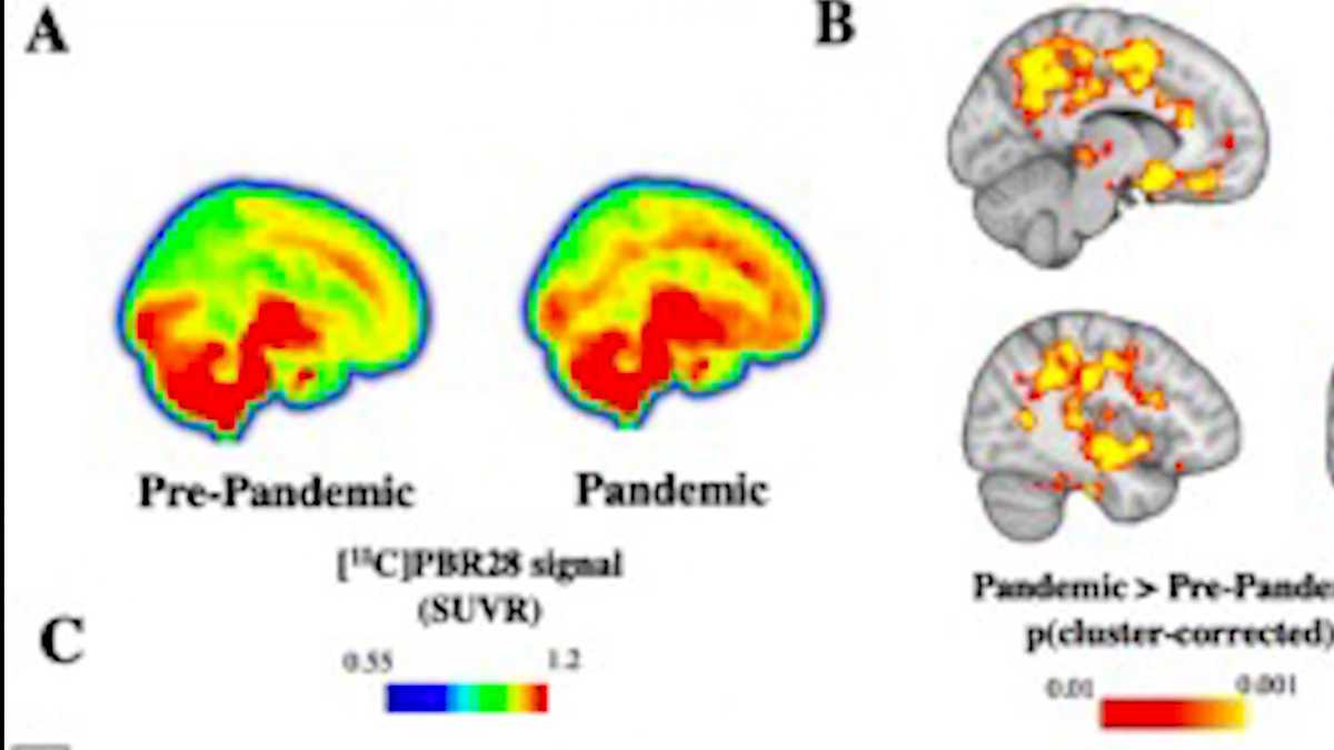 MGH study: COVID-19 lockdowns affected brain health of uninfected