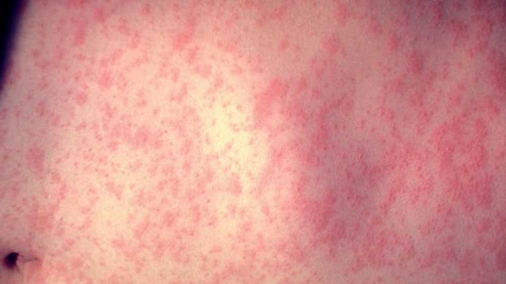 Child infected with measles visited several South Shore locations