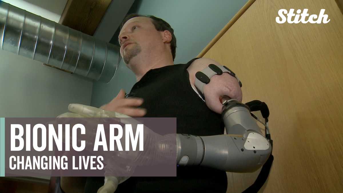 Man finds hope with cutting-edge prosthetic arm