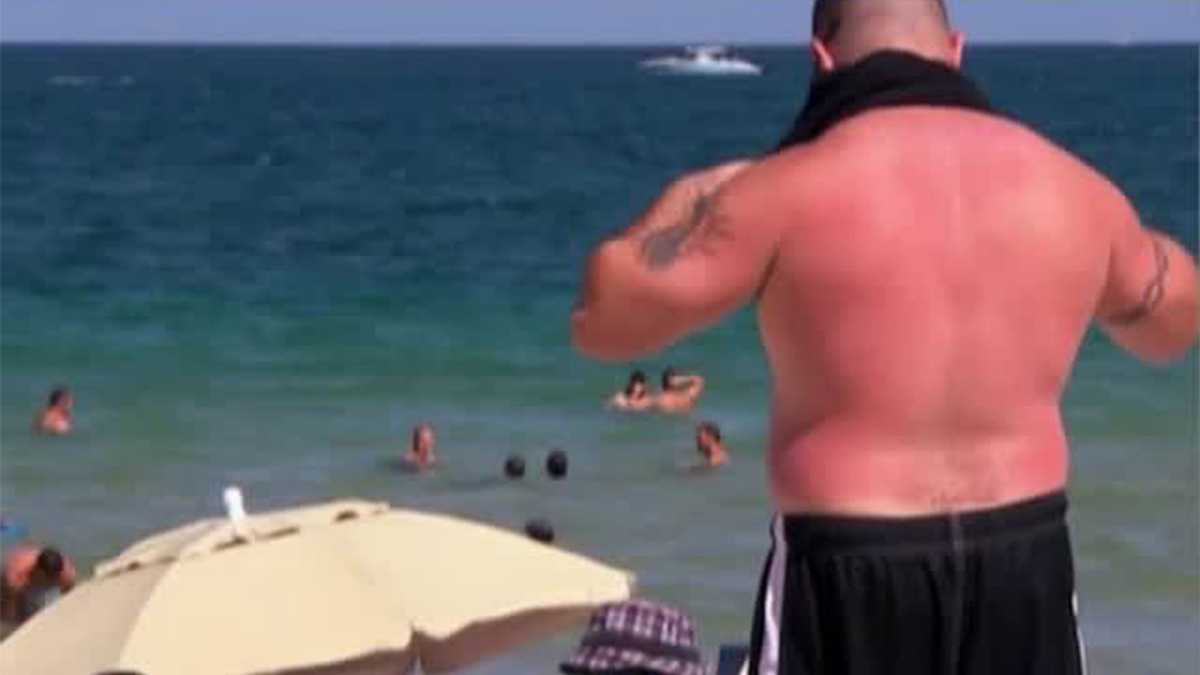 Boston doctor shares tips on preventing, treating sunburns
