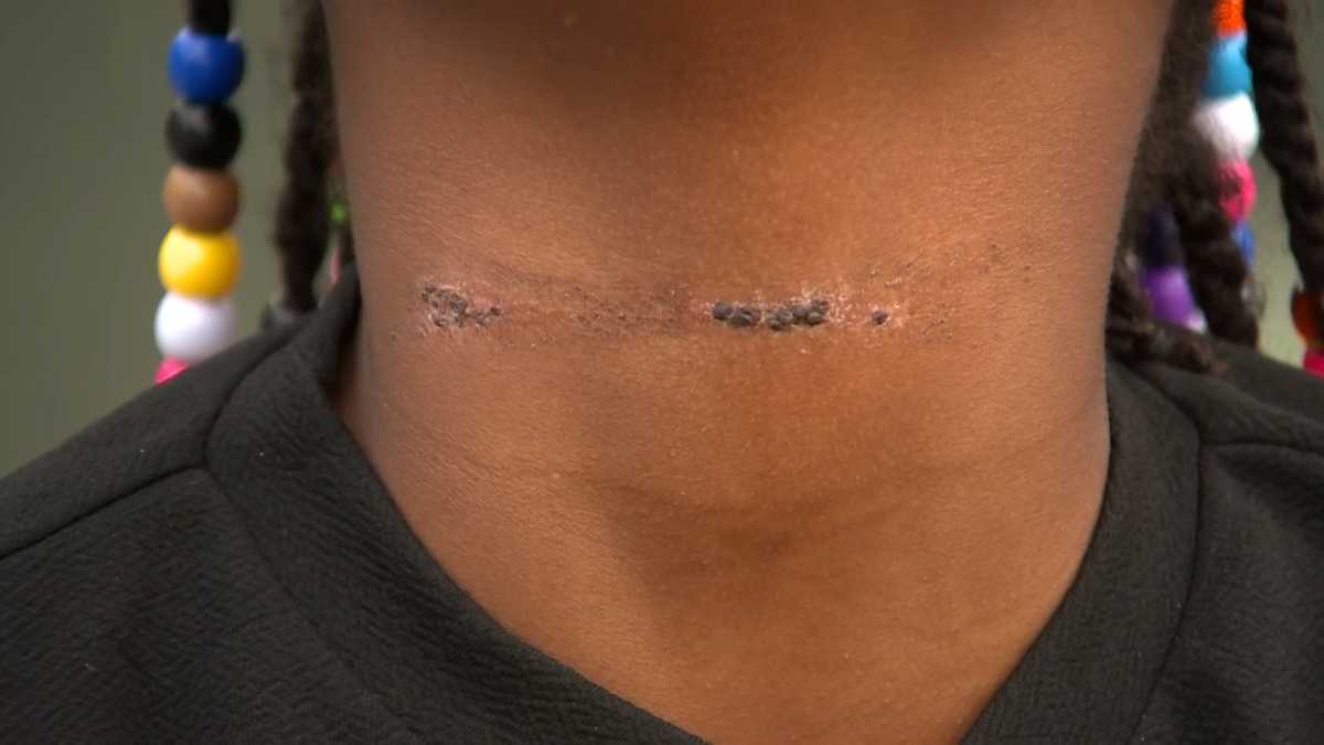 Taunton girl returns home from school with rope burns on neck